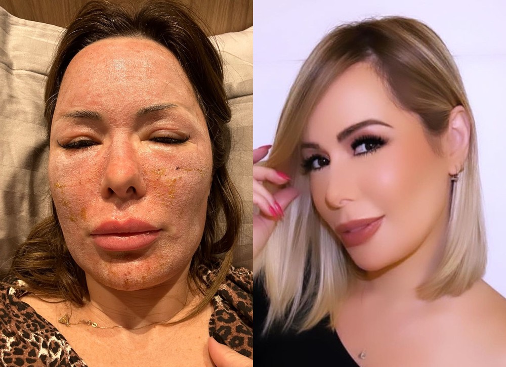 Ju Isen choca ao mostrar resultado do rosto após procedimento estético ...