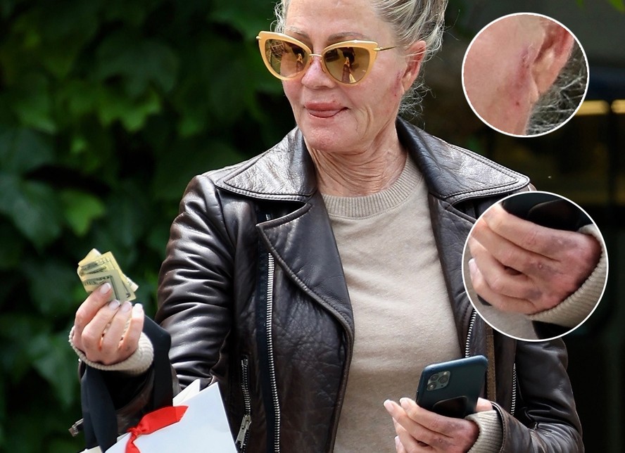 Melanie Griffith é vista com hematomas no rosto e mãos ao sair de ...