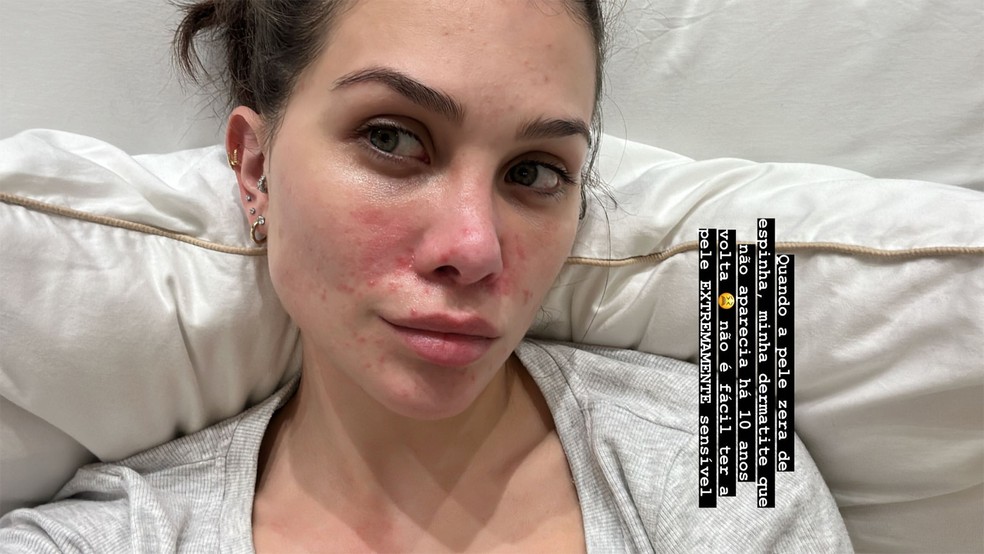 Flavia Pavanelli mostra rosto com dermatite: 'Não aparecia há 10 anos'