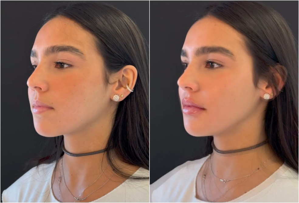 Namorada de Benício Huck mostra antes e depois de harmonização: 'Me ...