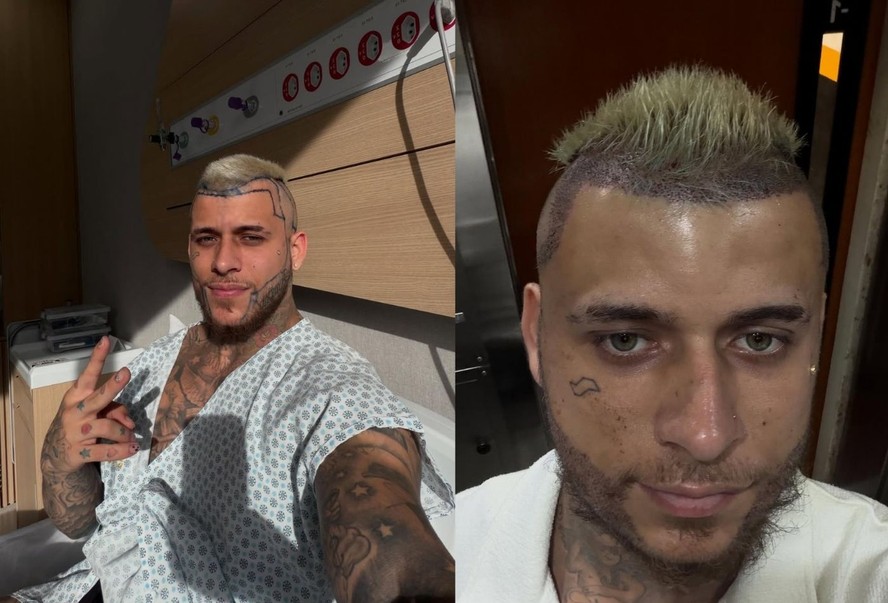 MC Pedrinho faz implante capilar e choca web com o rosto inchado: 'Ri ...
