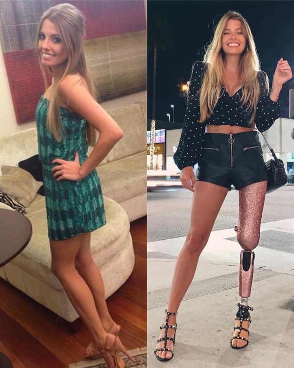 Paola Antonini reflete nos 9 anos do acidente no qual perdeu a perna: 'Presente'