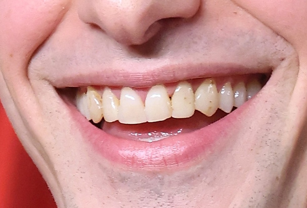 andy samberg teeth