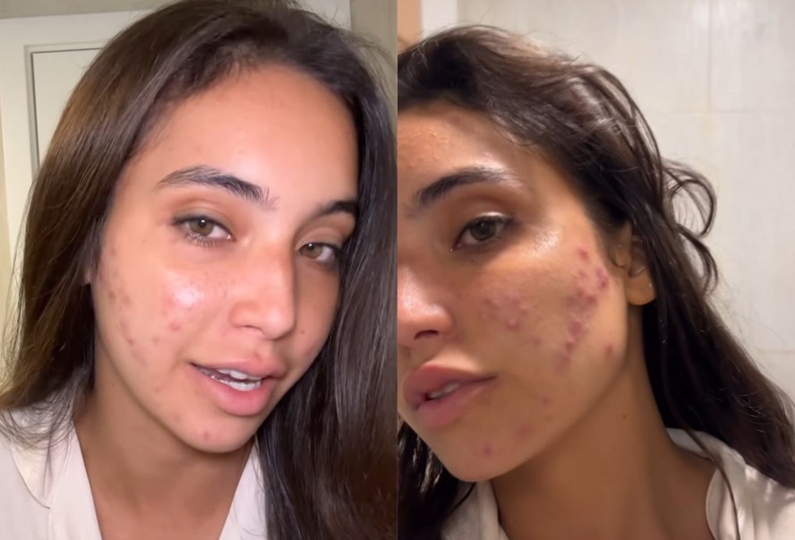 Especialistas explicam causas e formas de tratar a acne, doença da ex ...