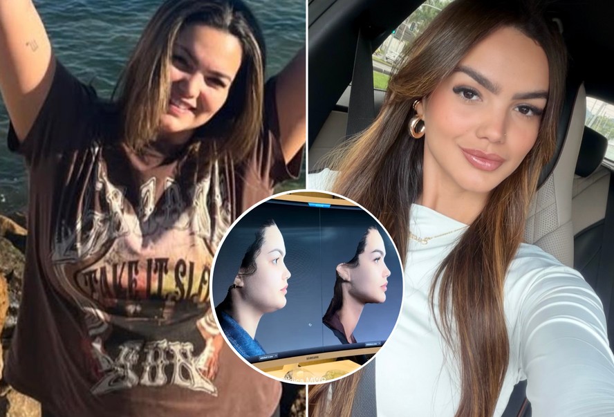Médica explica cuidados com rosto de Suzanna Freitas na perda de peso ...