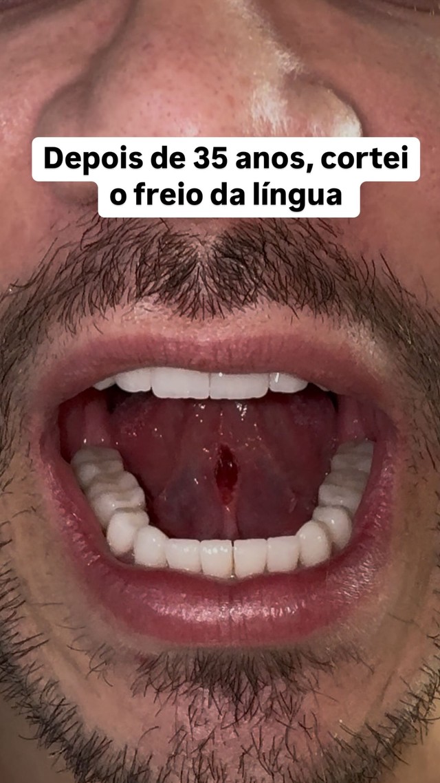 Eliezer mostra antes e depois de cirurgia para retirar freio da língua ...