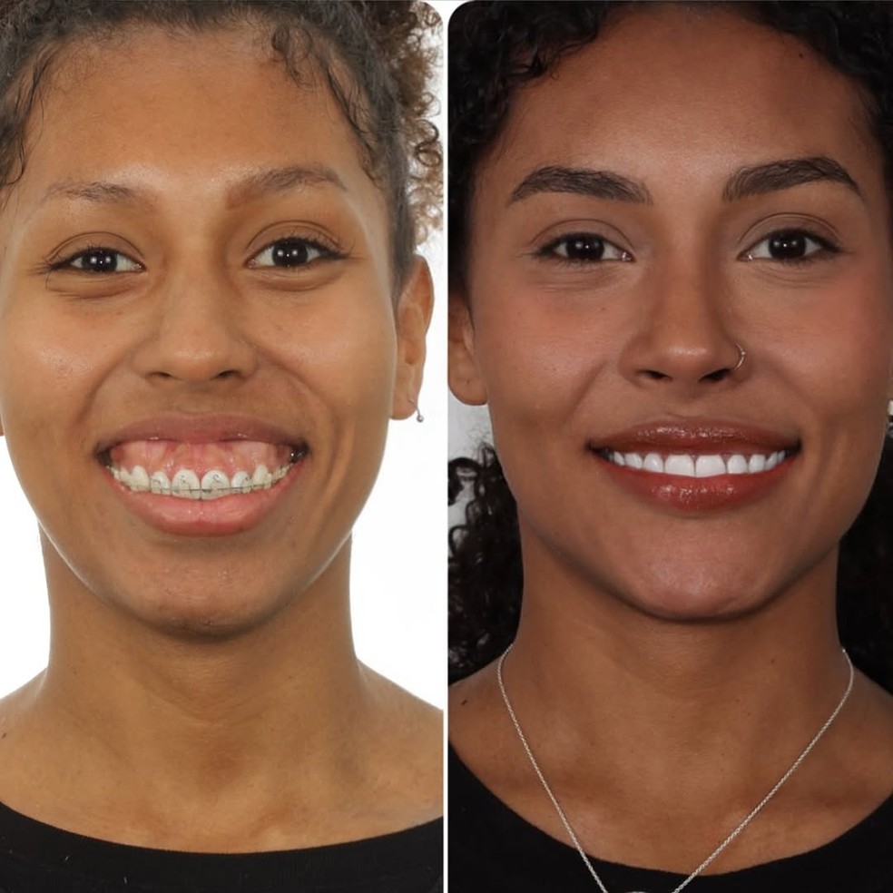 BBB 25: Giovanna Jacobina fez enxerto de gordura da barriga no rosto ...