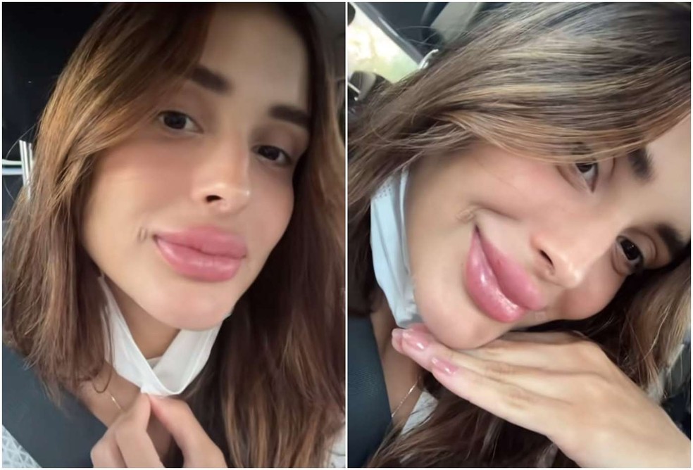 Letícia Almeida retira preenchimento dos lábios e mostra inchaço da boca