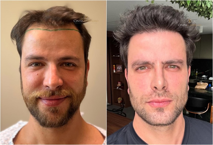 Ex-BBB Gustavo Marsengo celebra resultado de transplante capilar: '17 ...