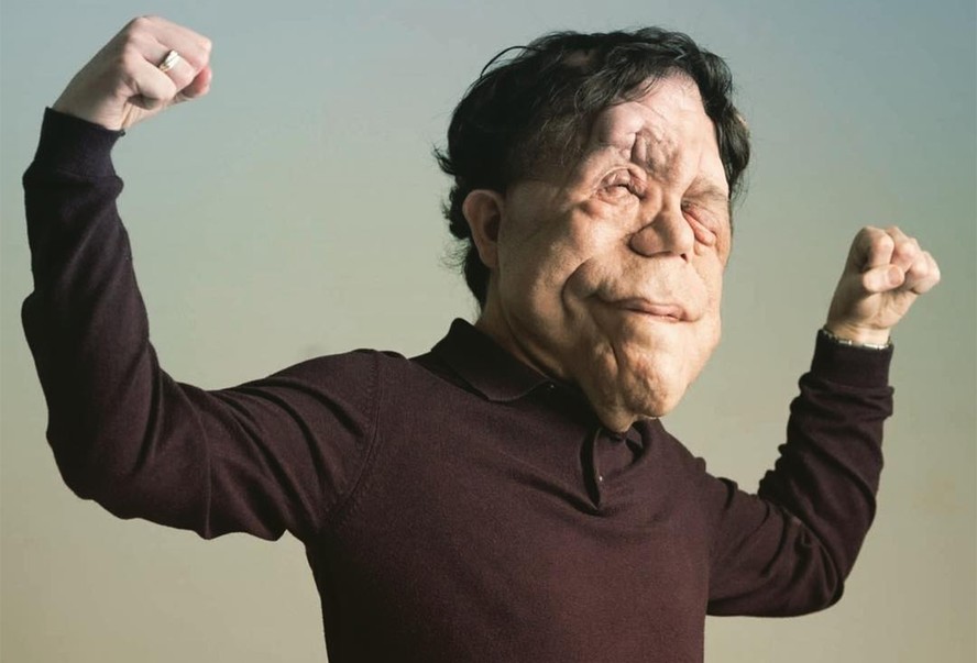 Quem é Adam Pearson? Ator com doença rara já fez 39 cirurgias e perdeu ...
