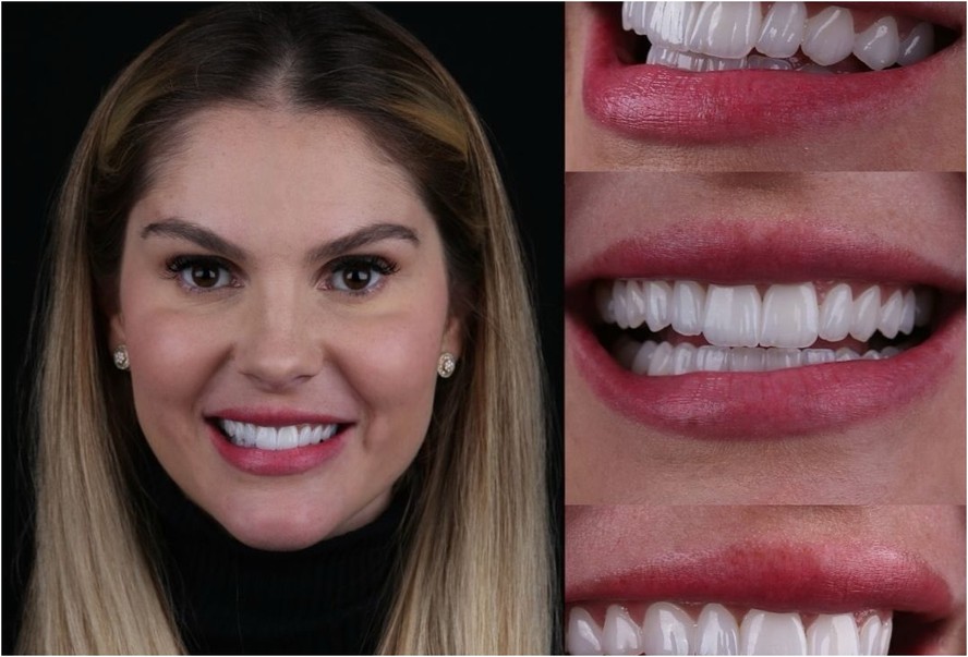 Bárbara Evans mostra mudanças após troca de lentes dentais e ...