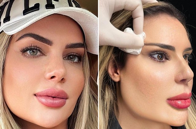 Denise Rocha se submete ao procedimento 'olhos de raposa'; compare