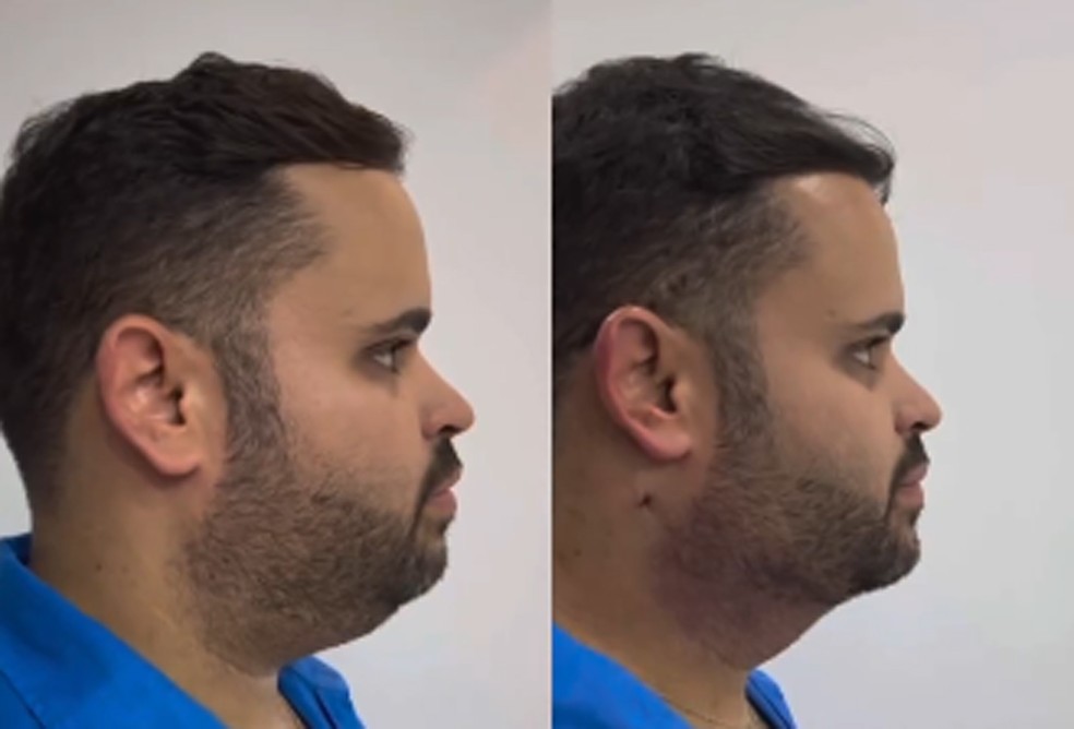 Ex-BBB Michel, do BBB 24, começa harmonização facial; compare