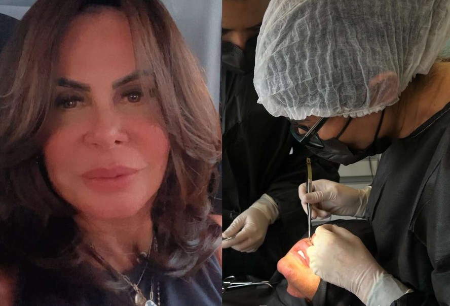 Gretchen explica retirada de preenchimento nos lábios: 'Estava pesando'