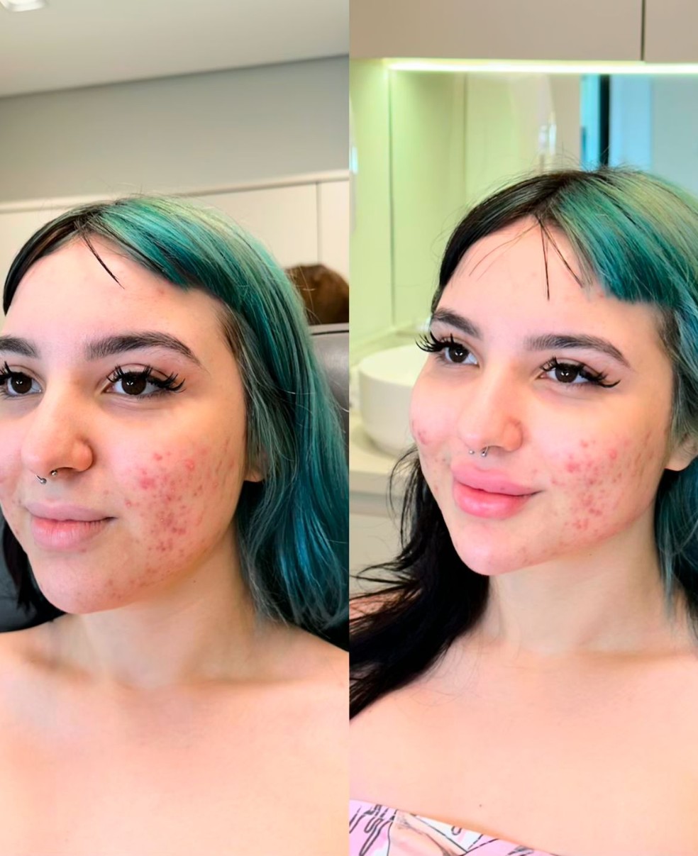 Influenciadora Belle Belinha faz harmonização facial; veja antes e depois