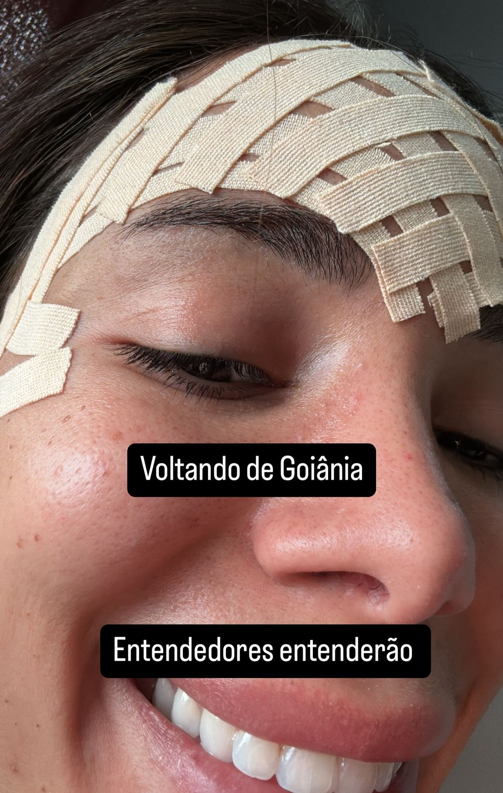 Anitta retira veia da testa! Médico explica procedimento e riscos; entenda