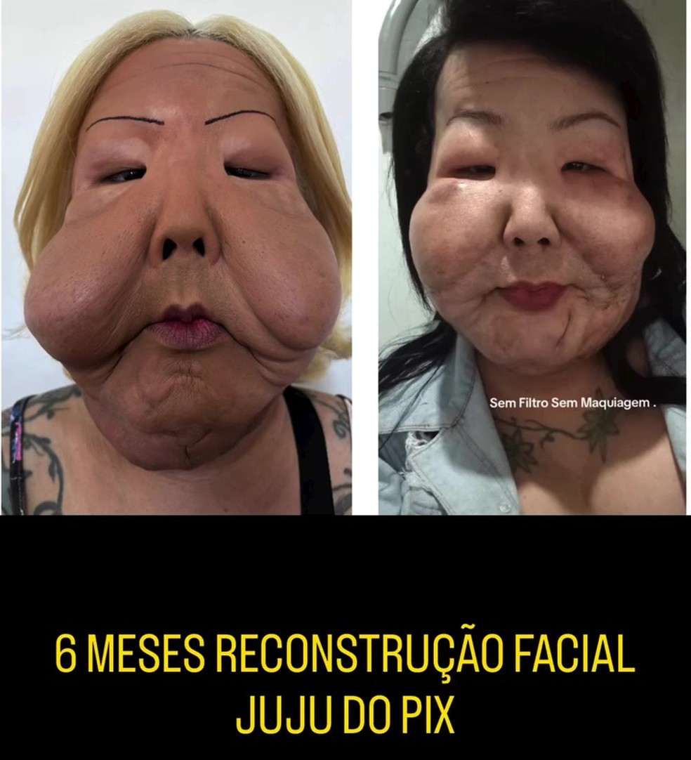 Médico mostra Juju do Pix antes e depois de retirar óleo mineral do ...