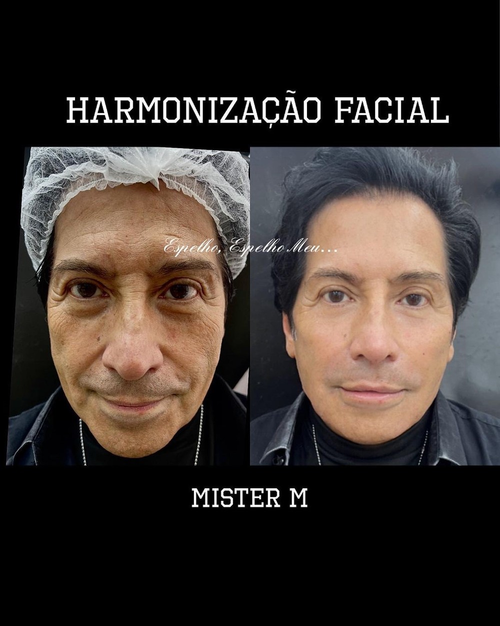 Lembra dele? Mister M faz harmonização facial e é comparado a Silvio ...