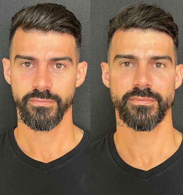 Jogador Radamés passa por harmonização facial; veja antes e depois