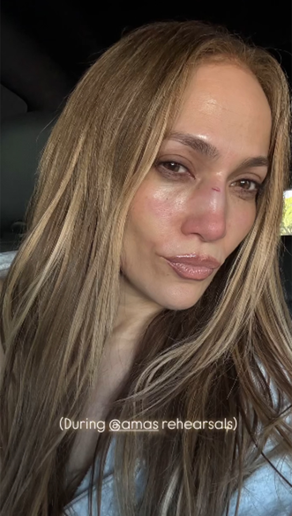 Jennifer Lopez leva pontos no rosto após acidente em ensaio de ...
