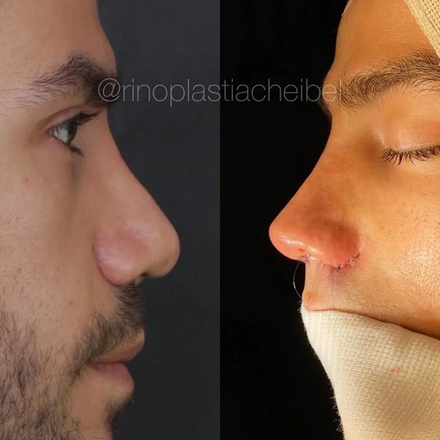 Relembre mais 5 famosos que fizeram rinoplastia reparadora assim como ...