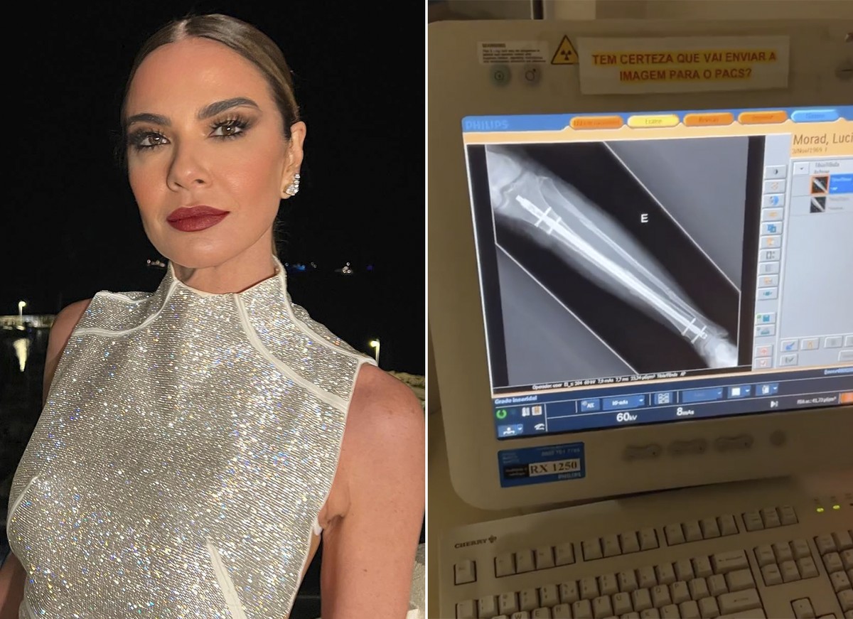 Luciana Gimenez se choca ao fazer exame em perna quebrada em acidente ...