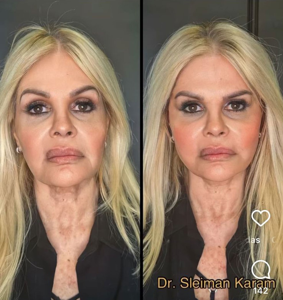 Monique Evans compartilha resultado de harmonização facial: 'Chocada e ...