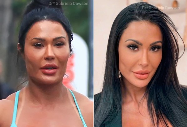 Gracyanne Barbosa, GKay, Eliezer: Veja 11 famosos que reverteram ...