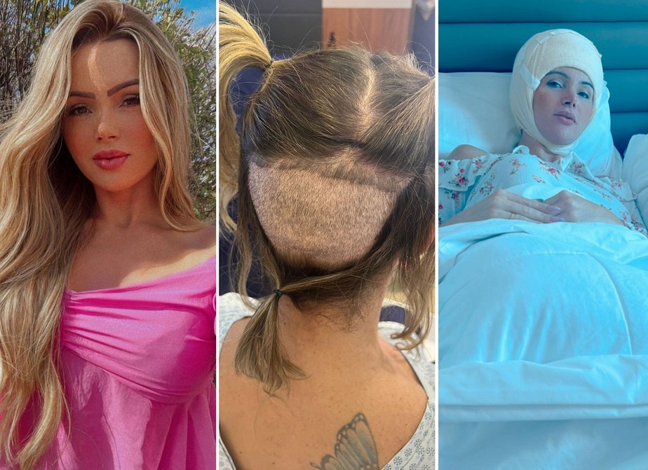 Thalita Zampirolli faz transplante capilar avaliado em R$ 50 mil