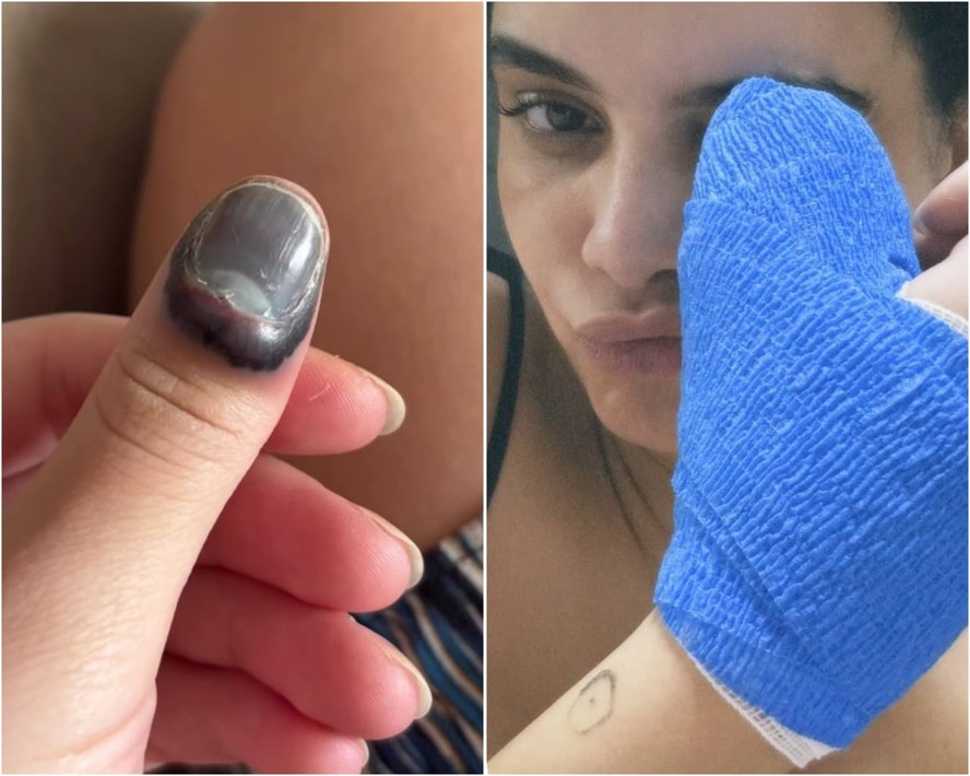 Carol Macedo passa por cirurgia após prender dedo na porta do carro