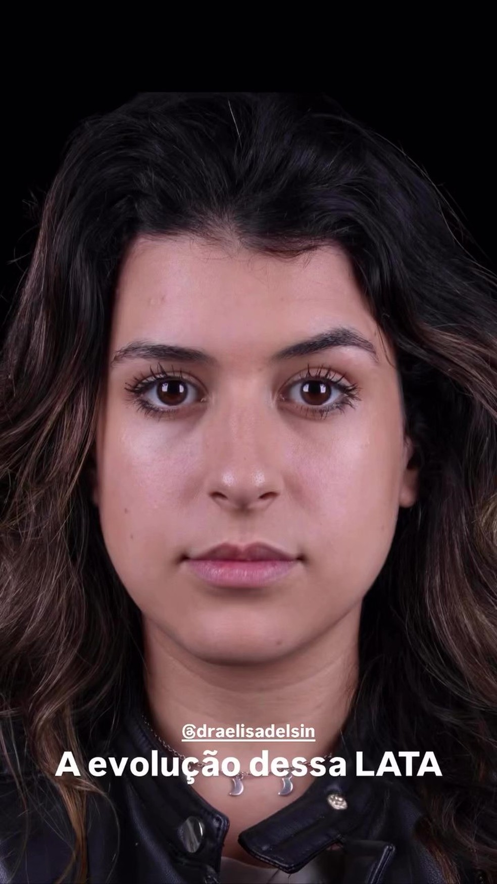 Luana Zucoloto atualiza harmonização facial pro casamento e compara com ...