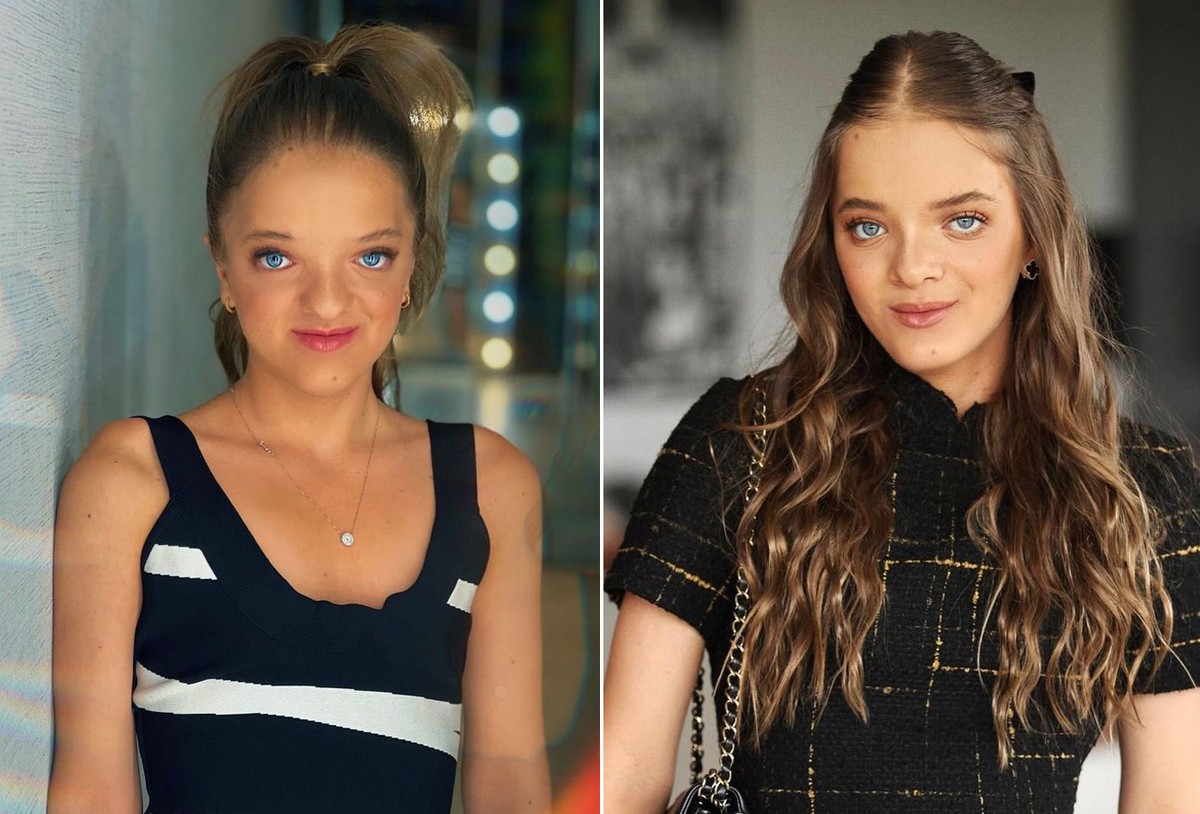 Cirurgia ortognática: saiba quando o procedimento feito por Rafa Justus ...