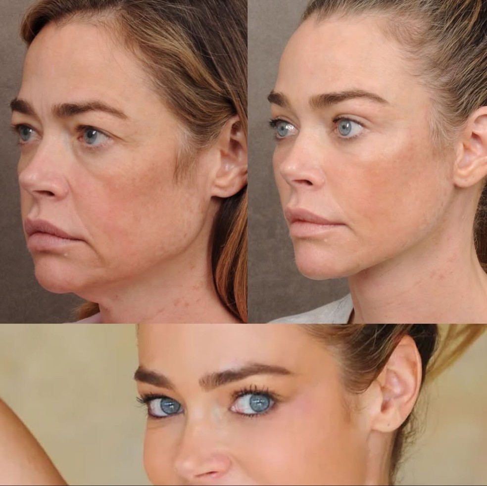 Atriz Denise Richards impressiona ao mostrar antes e depois de cirurgia ...