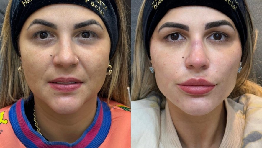 Deolane Bezerra fica 'passada' com resultado de lipoaspiração; veja o ...