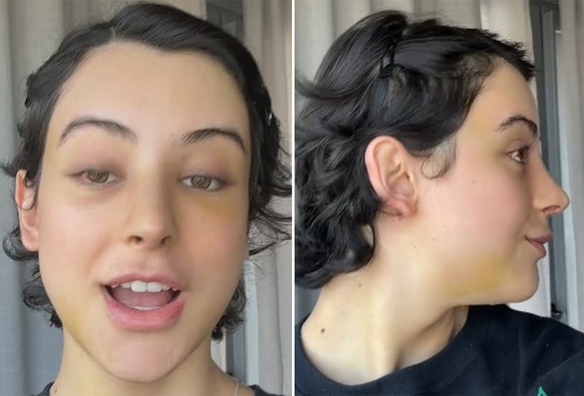 Sem curativos, Zé Longuinho mostra resultado de feminização facial; compare