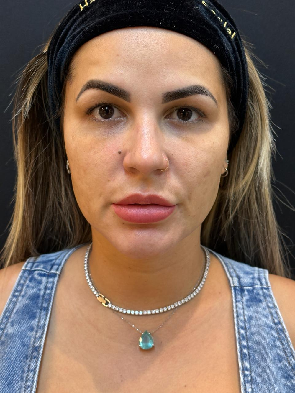 Deolane Bezerra mostra antes e depois após quase R$ 38 mil em ...