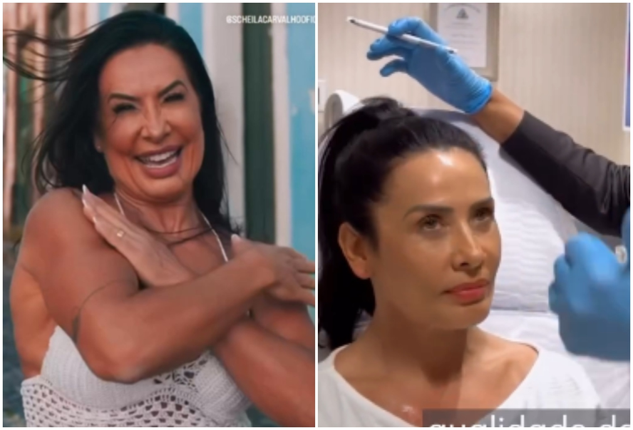Scheila Carvalho remove ácido hialurônico do rosto: 'Meu olhar abriu'