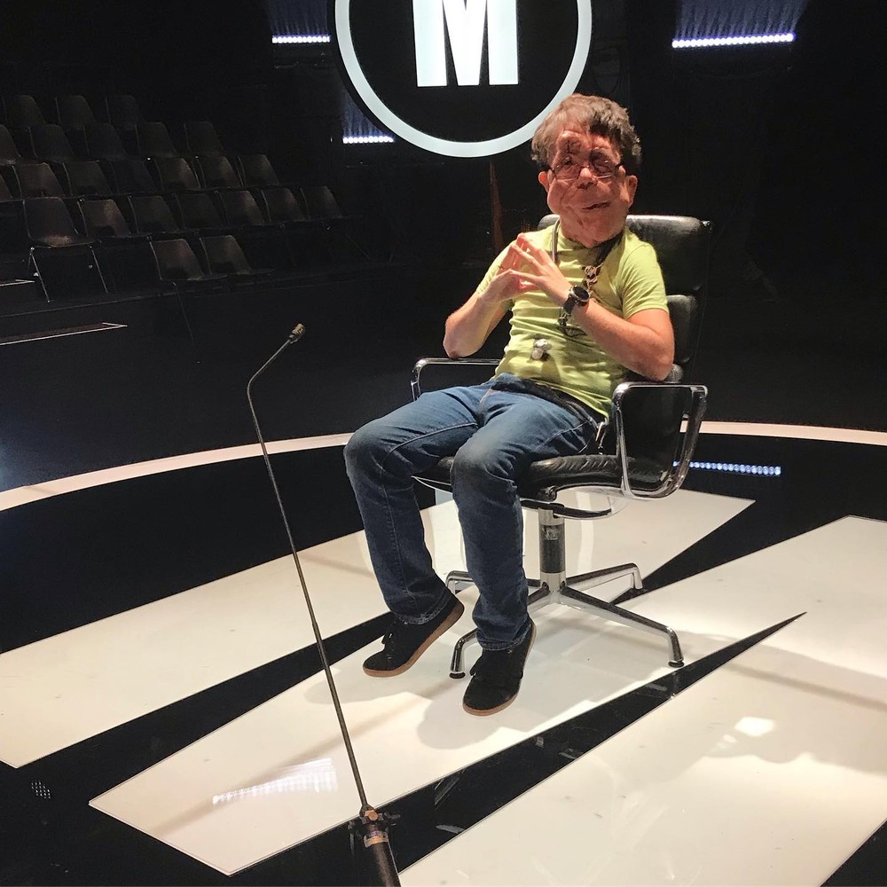 Quem é Adam Pearson? Ator com doença rara já fez 39 cirurgias e perdeu ...