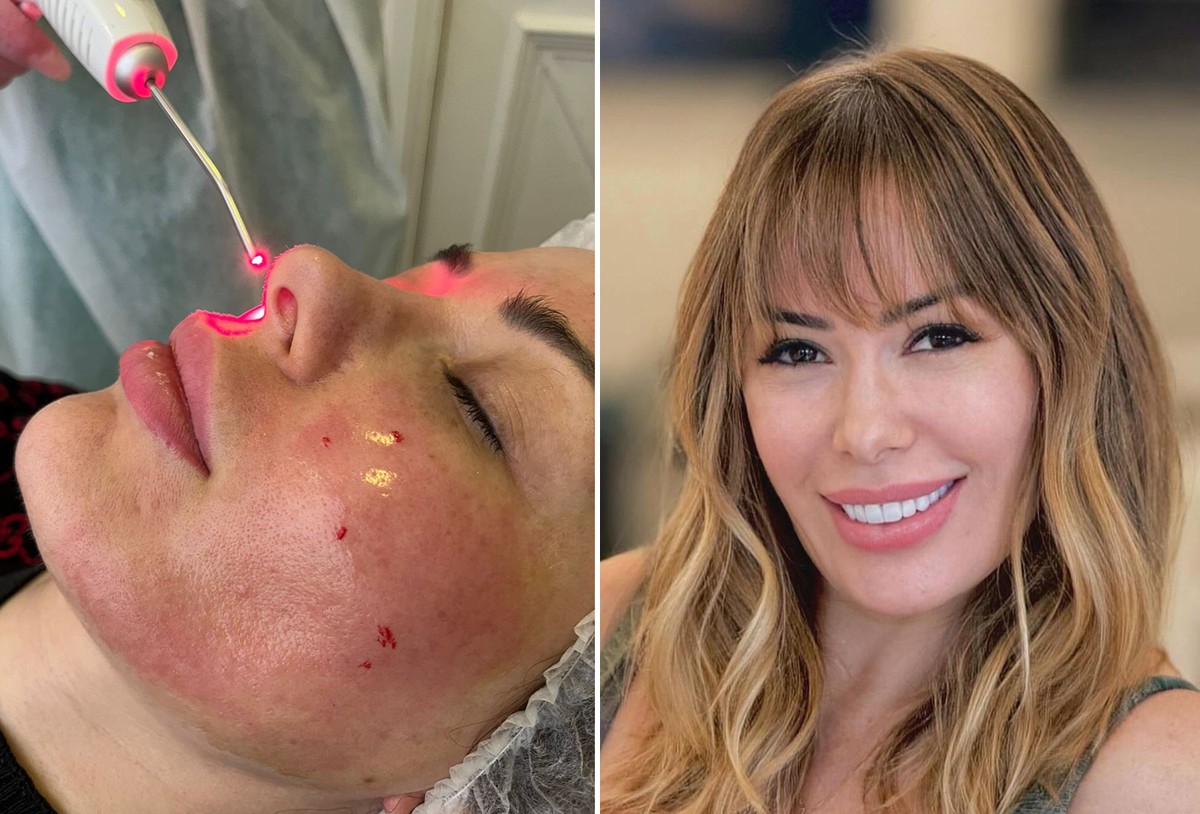 Com mais de R$ 300 mil em procedimentos, Ju Isen usa próprio sangue em tratamento facial