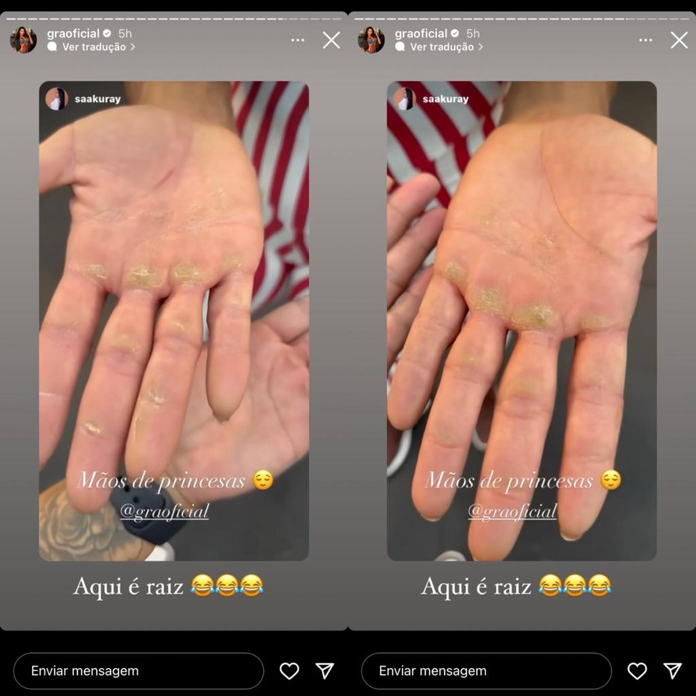 Gracyanne Barbosa mostra mãos cheias de calos devido aos treinos