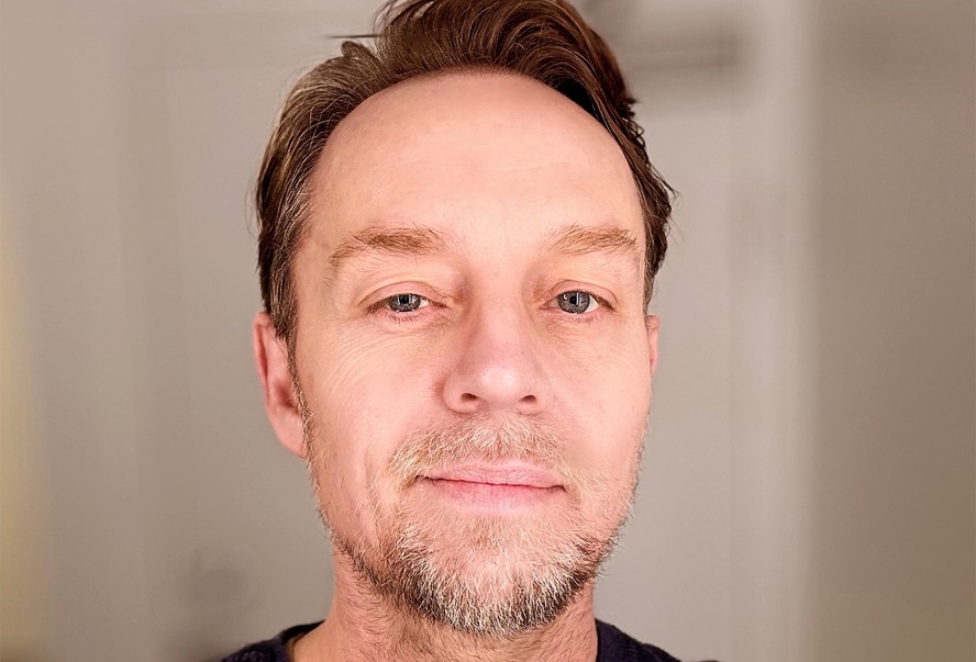 Cantor Darren Hayes quebra mandíbula e dentes após desmaios; veja a foto