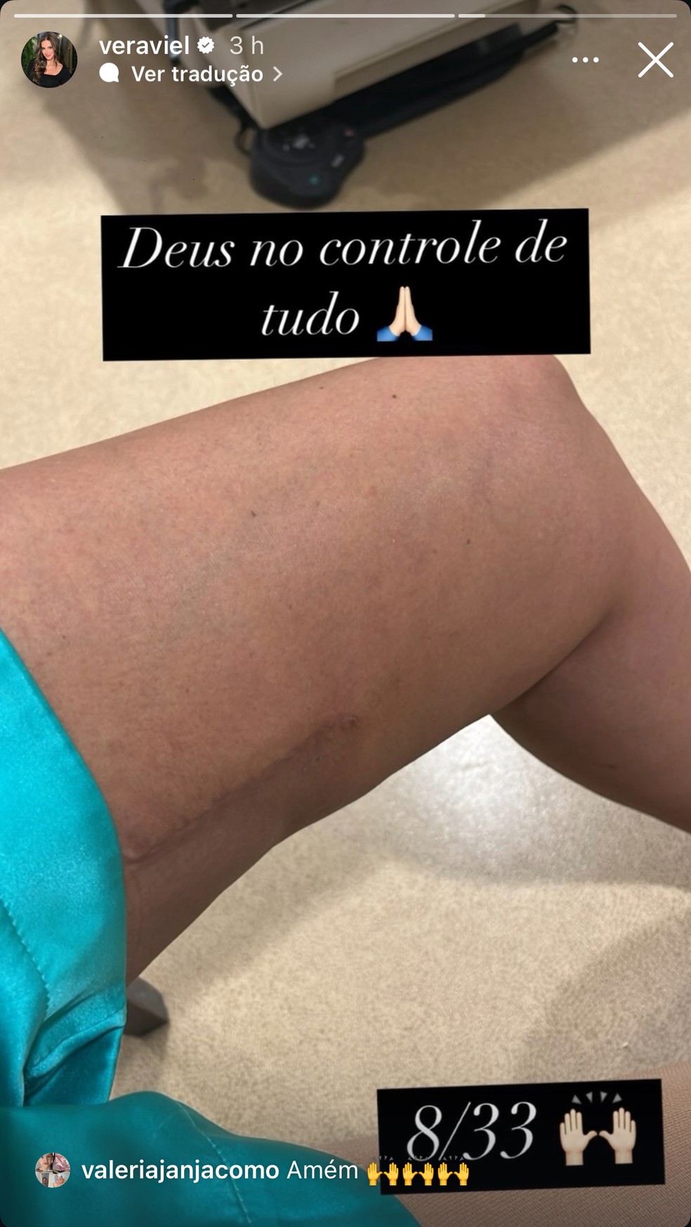 Vera Viel mostra recuperação da perna após cirurgia para retirada de câncer