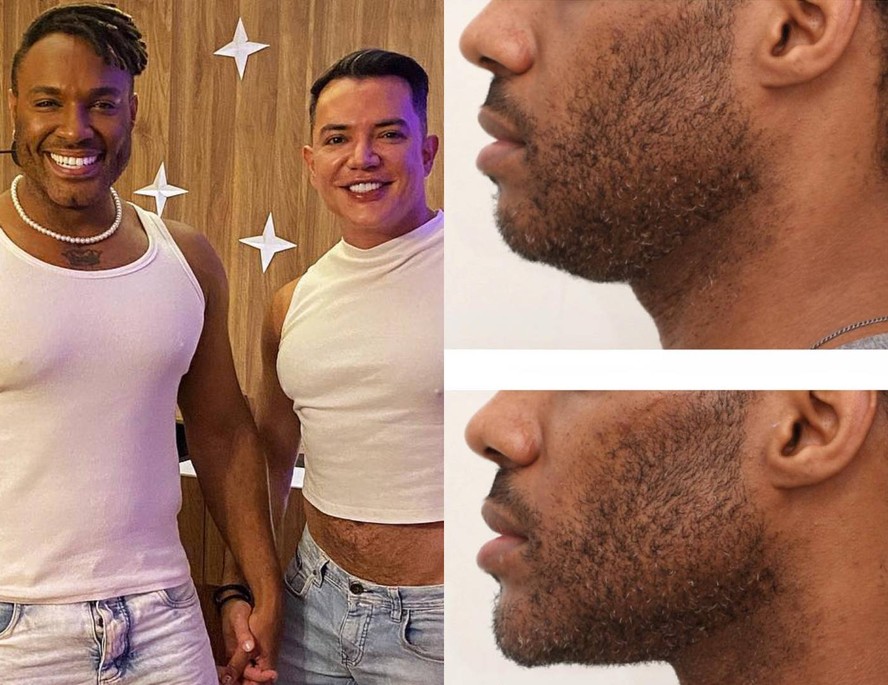 Marido mostra antes e depois do queixo de Fred Nicácio, e manda recado ...