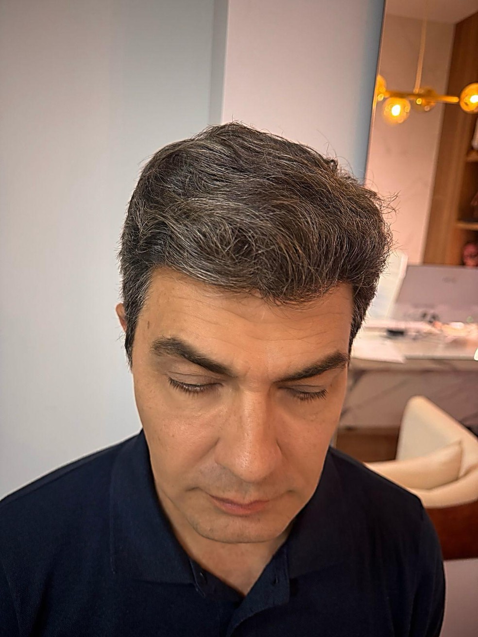 Ex-paquito faz implante capilar: 'Mexia com a autoestima'; antes e depois