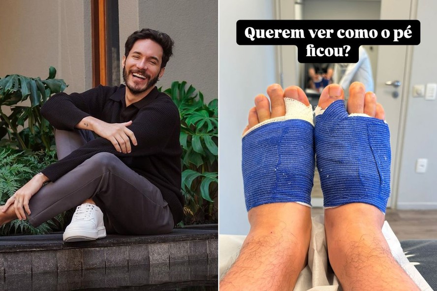 Eliezer mostra antes e depois de cirurgia para remover joanetes no pé