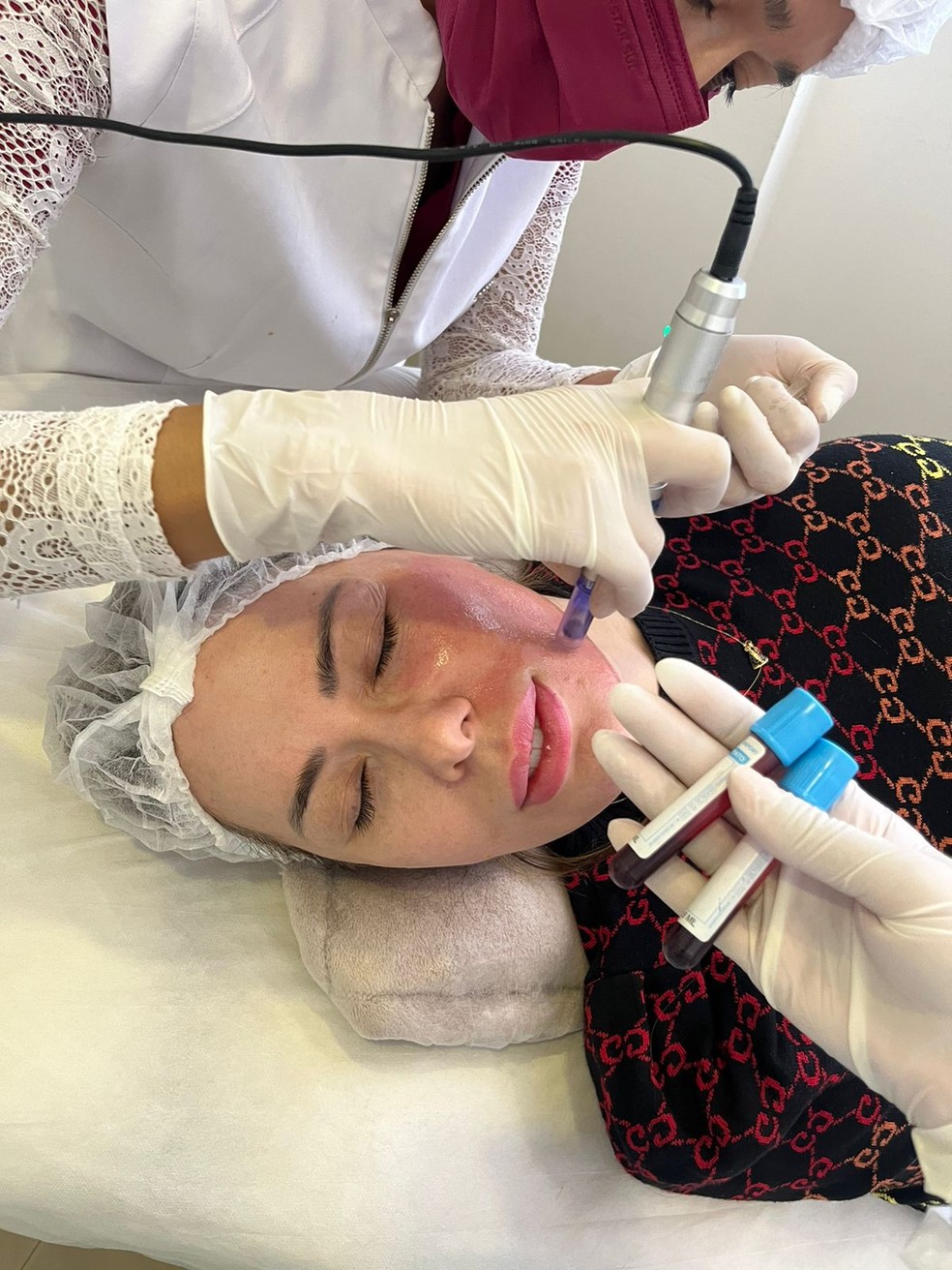 Com mais de R$ 300 mil em procedimentos, Ju Isen usa próprio sangue em tratamento facial