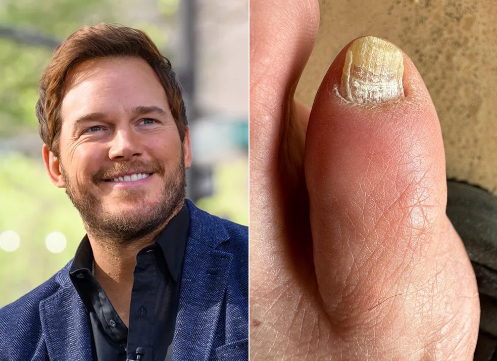 Chris Pratt choca com unha do pé horrorosa, e web reclama: 'Nojo'